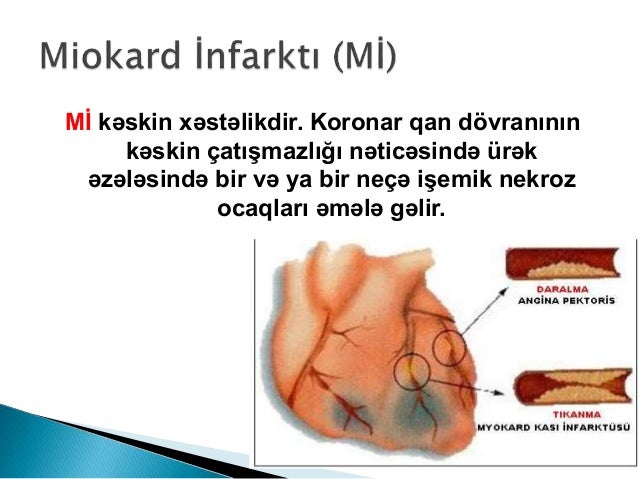 Miokard infarkti (Myocardia infarctus)