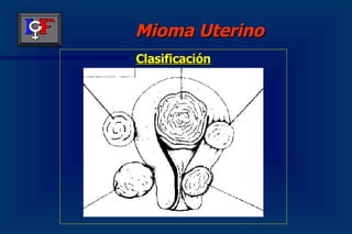 Mioma Uterino | PPT