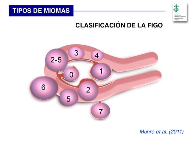 Miomas cuando operar
