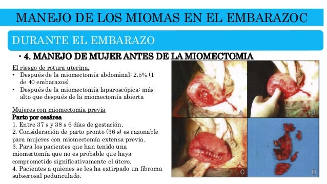 Miomas uterinos y el embarazo