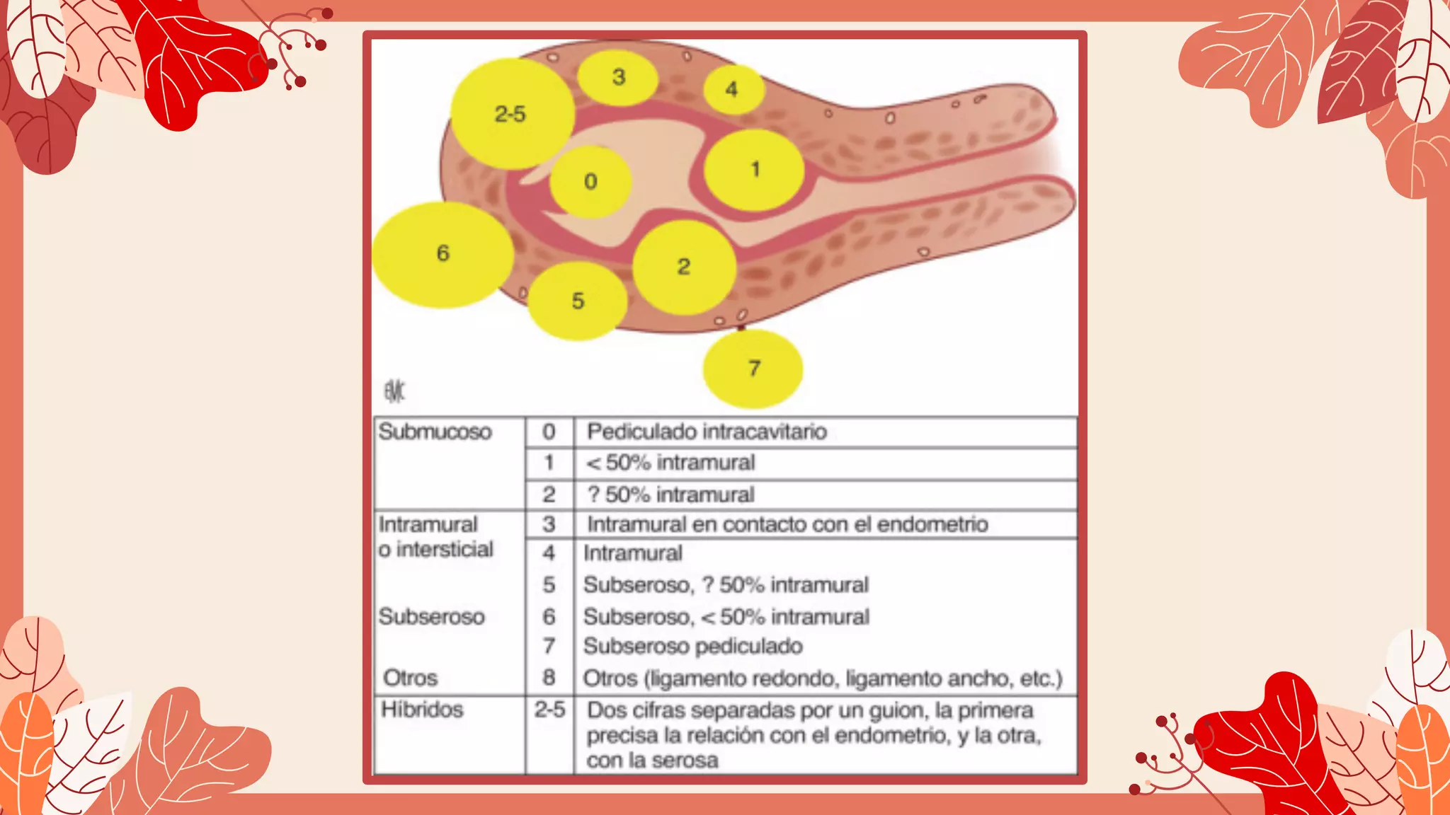 Miomas uterinos - Ginecología | PPT