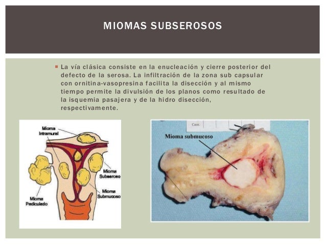 Miomatosis1