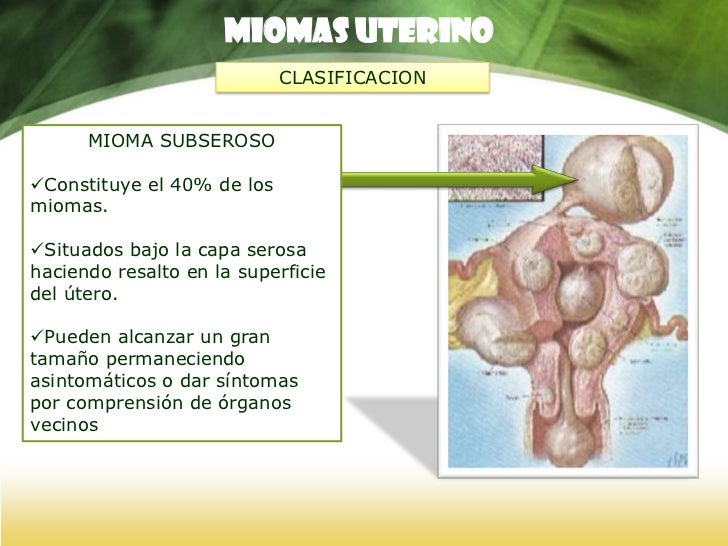 Miomatosis uterina