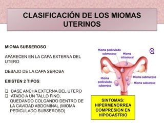 Miomatosis uterina | PPT