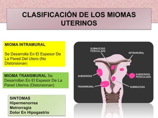 Miomatosis uterina | PPT