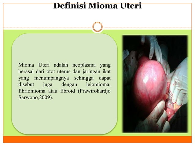 MIOMA_UTERI.pptx