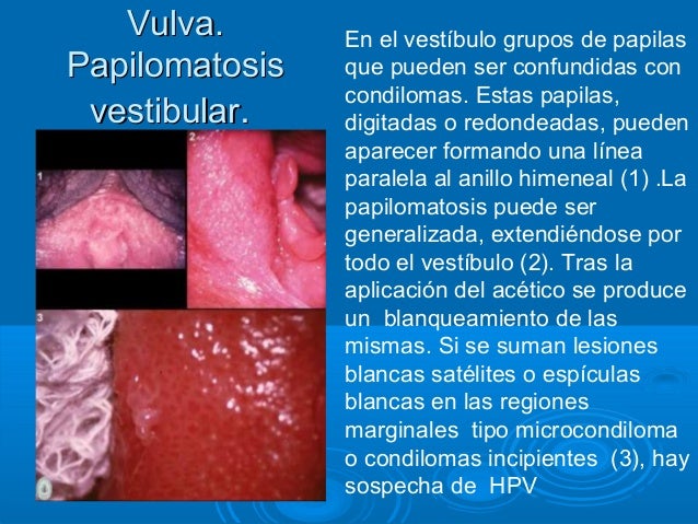 Papillomatose Physiologique De La Vulve – MMED