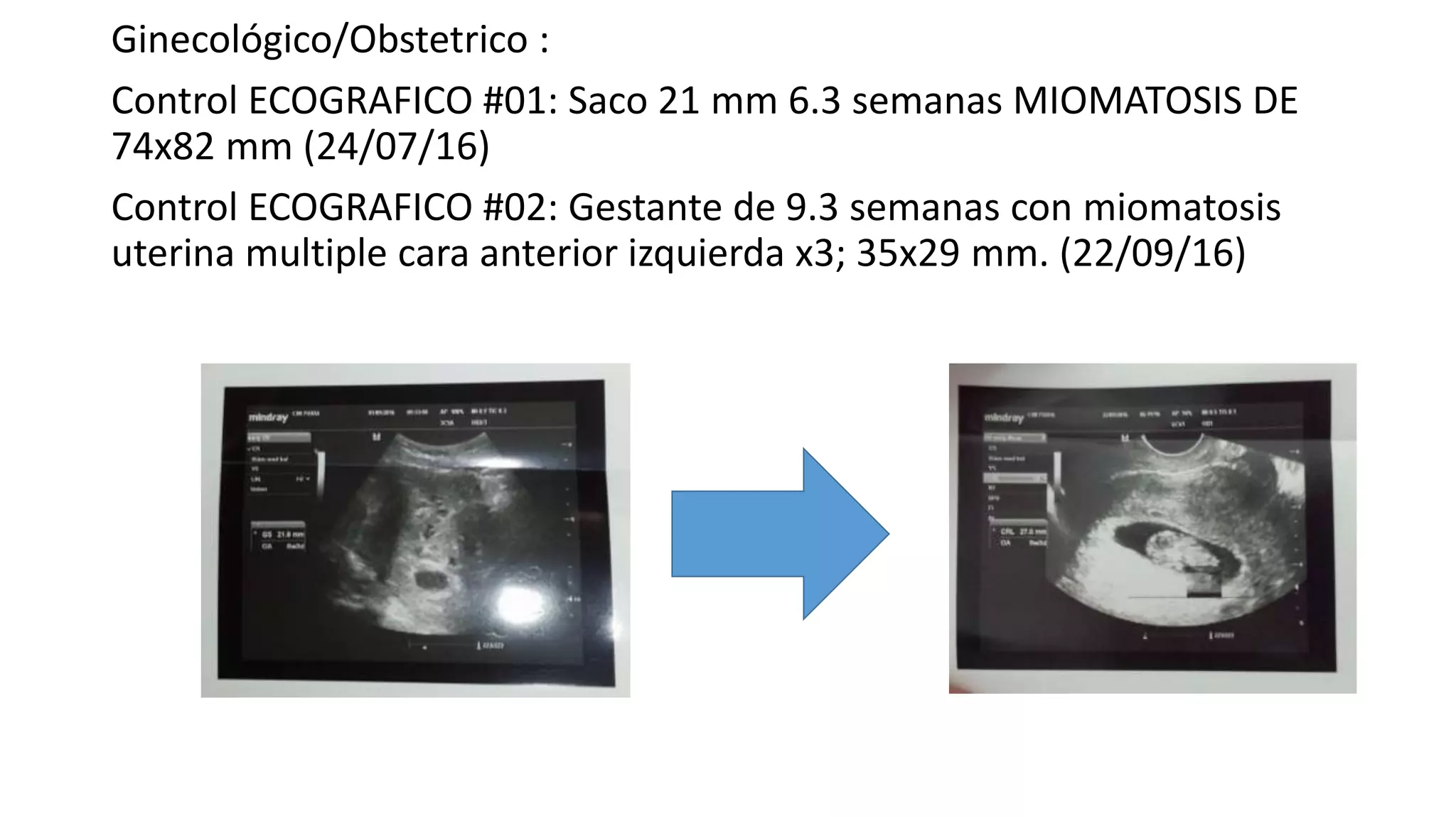 Caso clinico de miomas en embarazo | PPTX