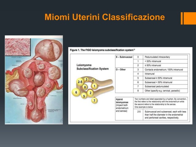 Silvio Liguori Miomectomia Sigo | PPTX