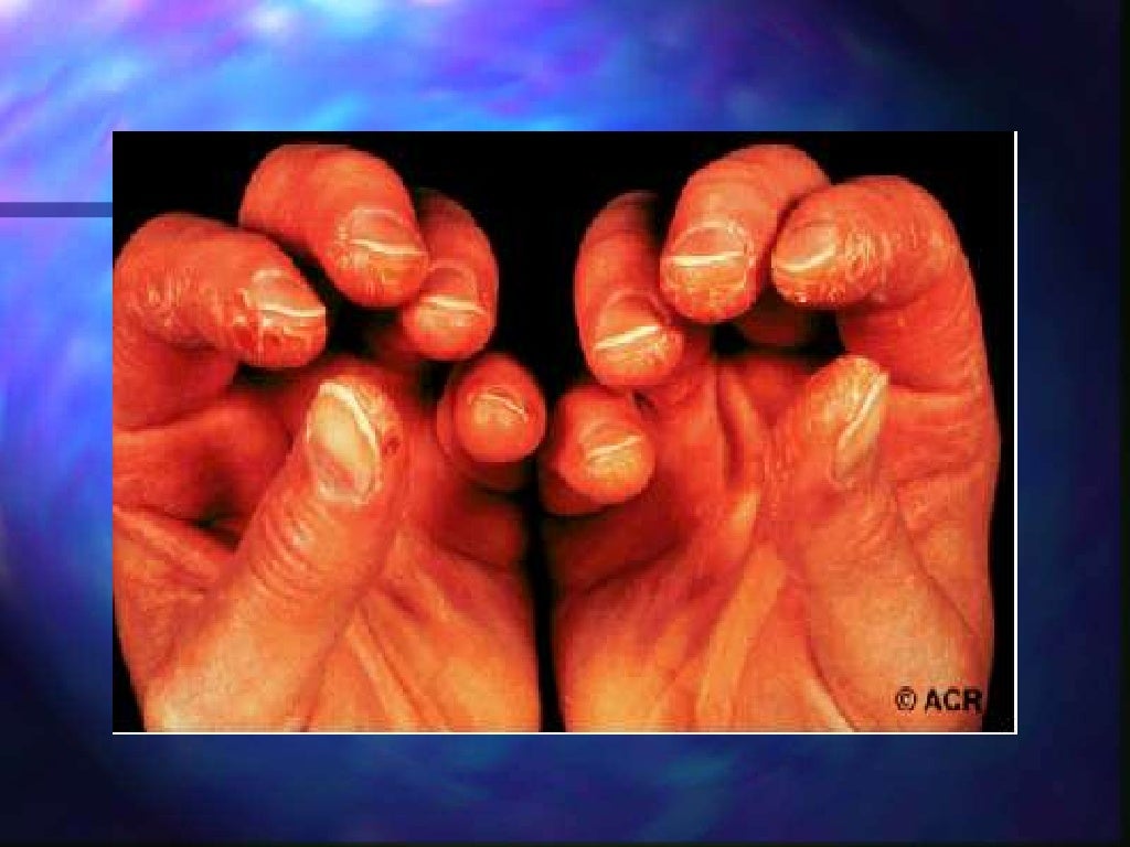 Miopatias Inflamatorias