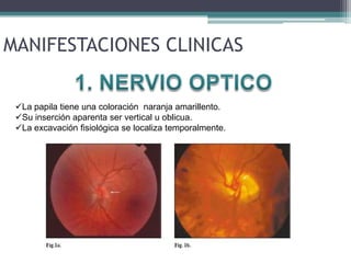 Miopia degenerativa | PPTX