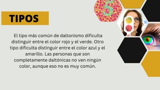 miopia y daltonismo Patología Visual y Ocular 03MOD | PPTX | Eye and Vision Conditions ...