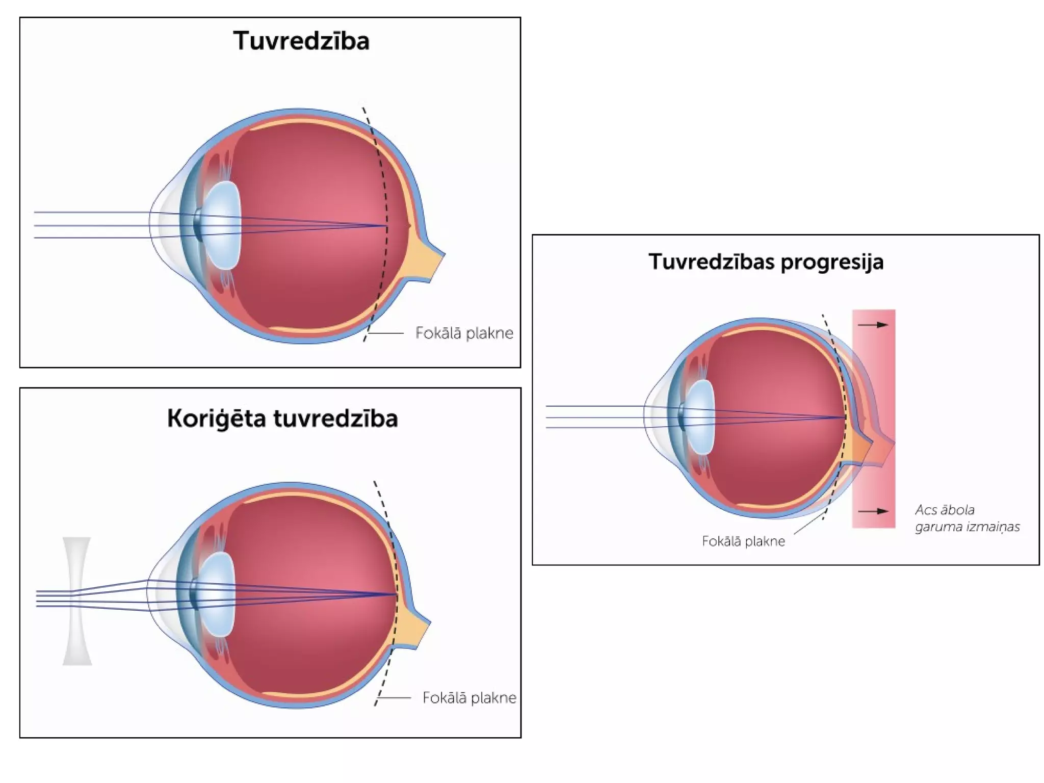 Miopijas kontrole | PPT