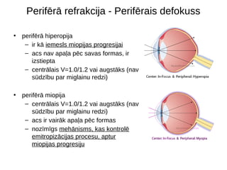 Miopijas kontrole | PPT