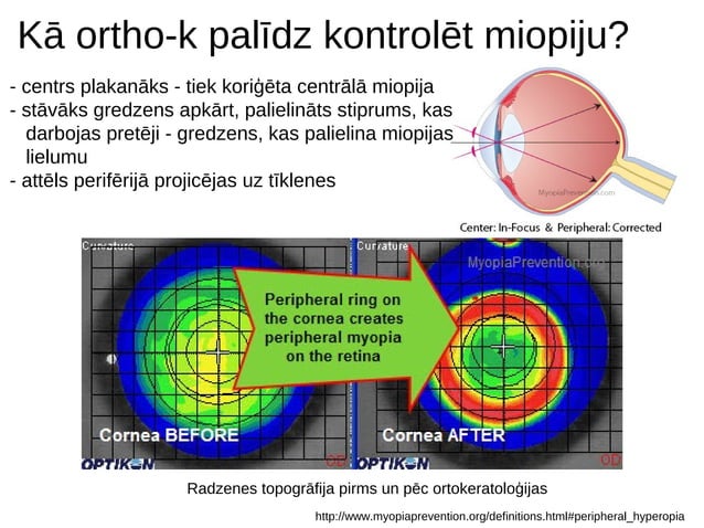 Miopijas kontrole | PPT | Free Download