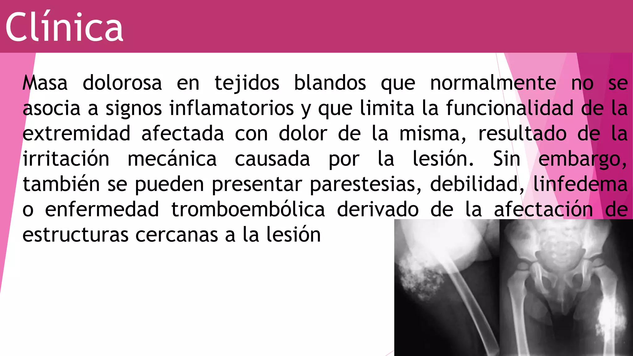 Miositis Osificante.pptx