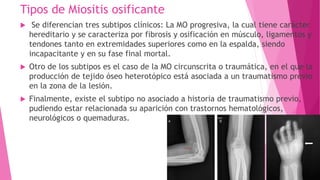 Miositis Osificante.pptx