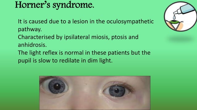 Miotics and mydriatics | PPTX | Eye and Vision Conditions | Diseases ...