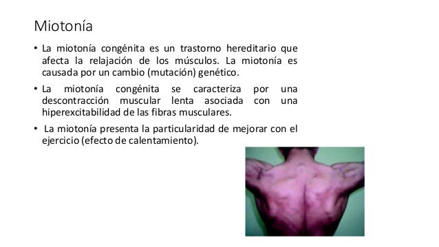 Miotonía congénita