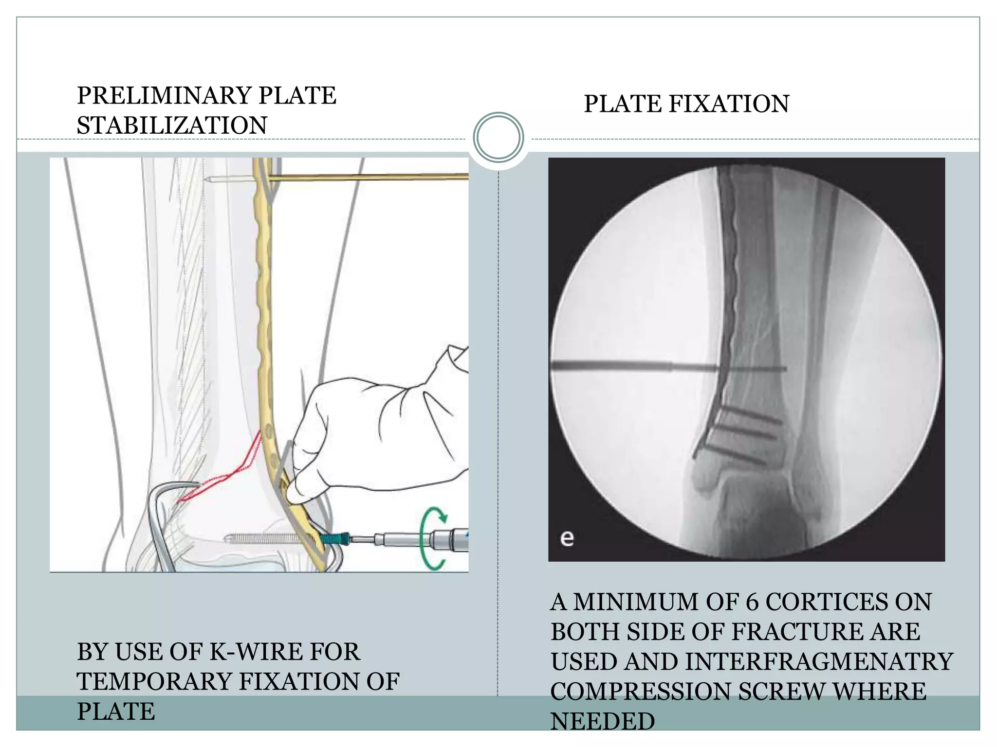 minimally invasive percutaneous plate osteosynthesis | PPTX