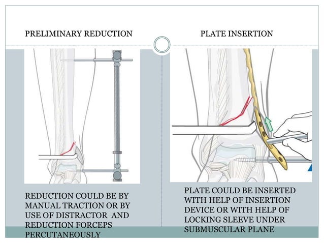 minimally invasive percutaneous plate osteosynthesis | PPTX
