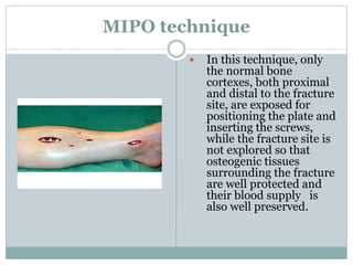 minimally invasive percutaneous plate osteosynthesis | PPTX