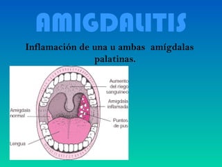 AMIGDALITIS | PPT