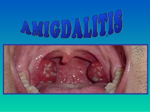 AMIGDALITIS