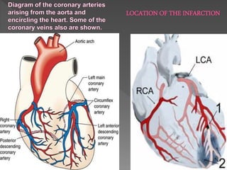 Myocardial infartion pathophysiology | PPTX