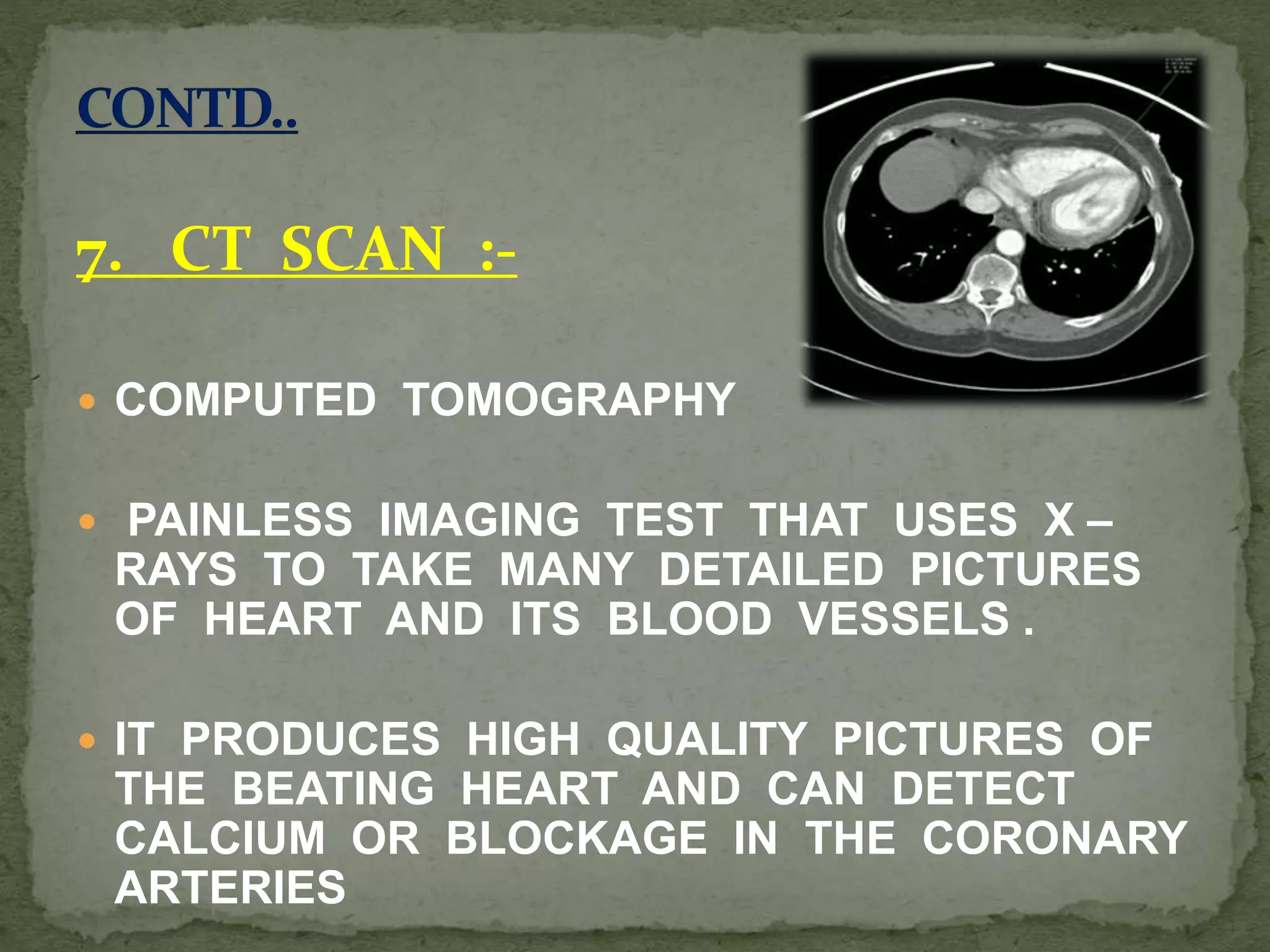 MYOCARDIAL INFARCTION [presentation ] | PPTX