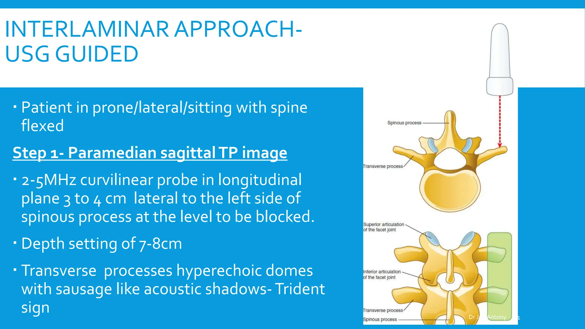 Minimally invasive pain and spine interventions for low back pain | PPTX