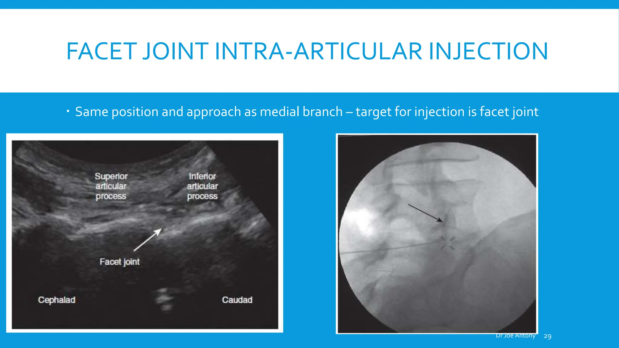 Minimally invasive pain and spine interventions for low back pain | PPTX
