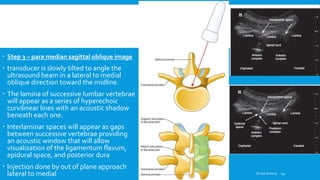 Minimally invasive pain and spine interventions for low back pain | PPTX
