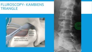Minimally invasive pain and spine interventions for low back pain | PPTX