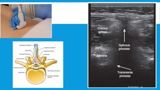 Minimally invasive pain and spine interventions for low back pain | PPTX