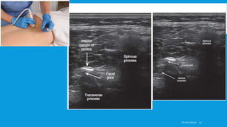 Minimally invasive pain and spine interventions for low back pain | PPTX