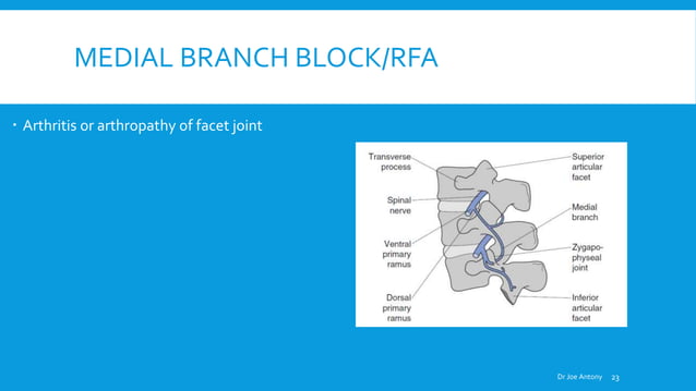 Minimally invasive pain and spine interventions for low back pain | PPTX