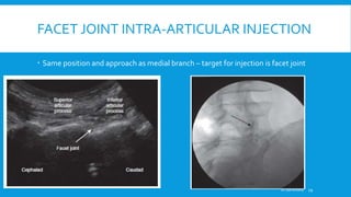 Minimally invasive pain and spine interventions for low back pain | PPTX
