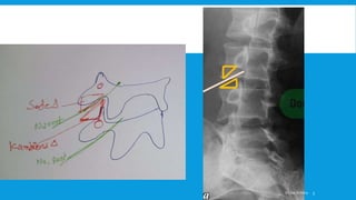 Minimally invasive pain and spine interventions for low back pain | PPTX