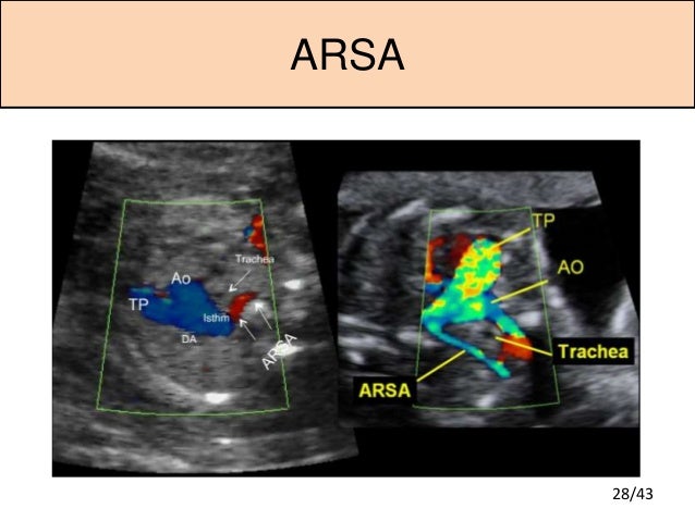 FETAL USG SOFT MARKER YAKLAŞIM
