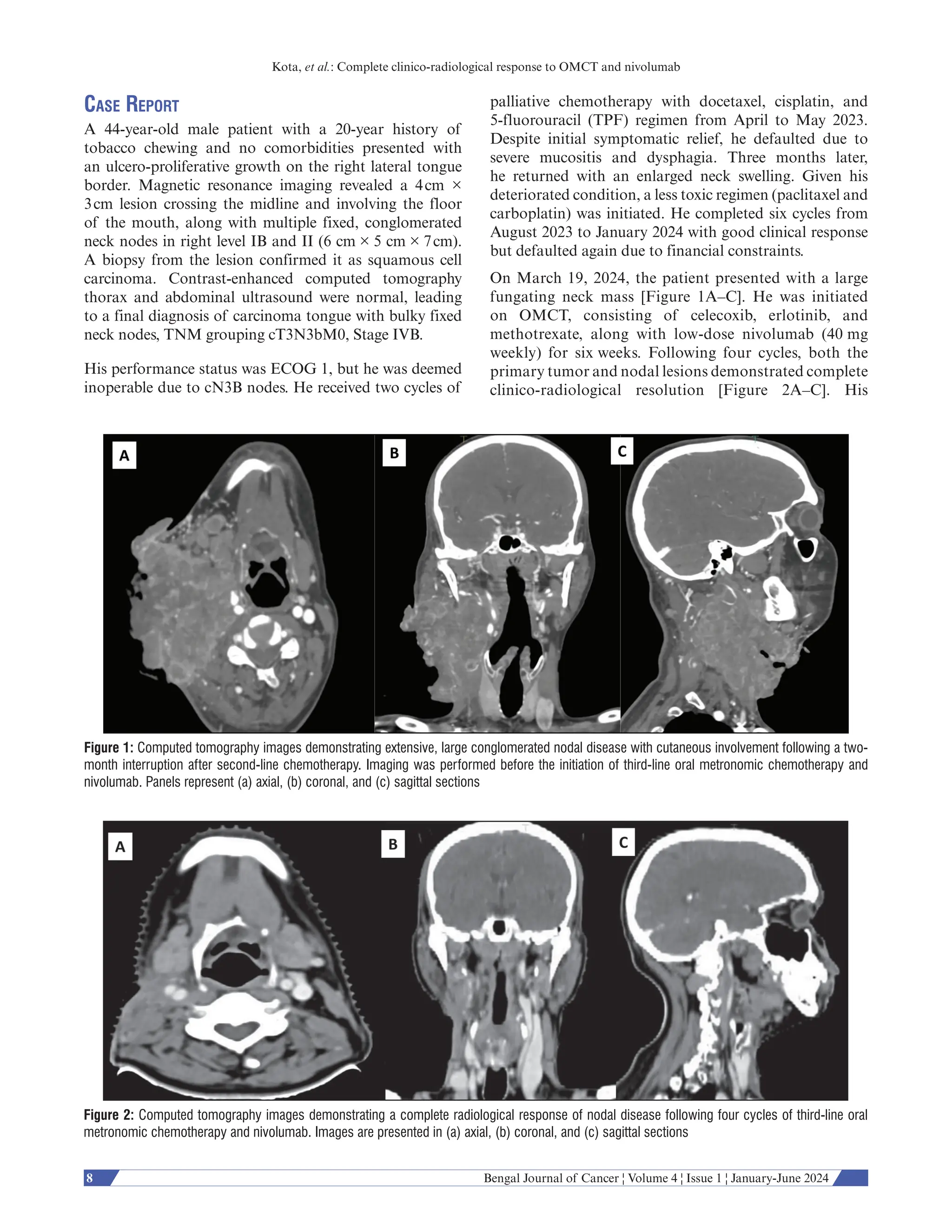 Miraculous Clinico-Radiological Complete Remission to Low-Dose ...