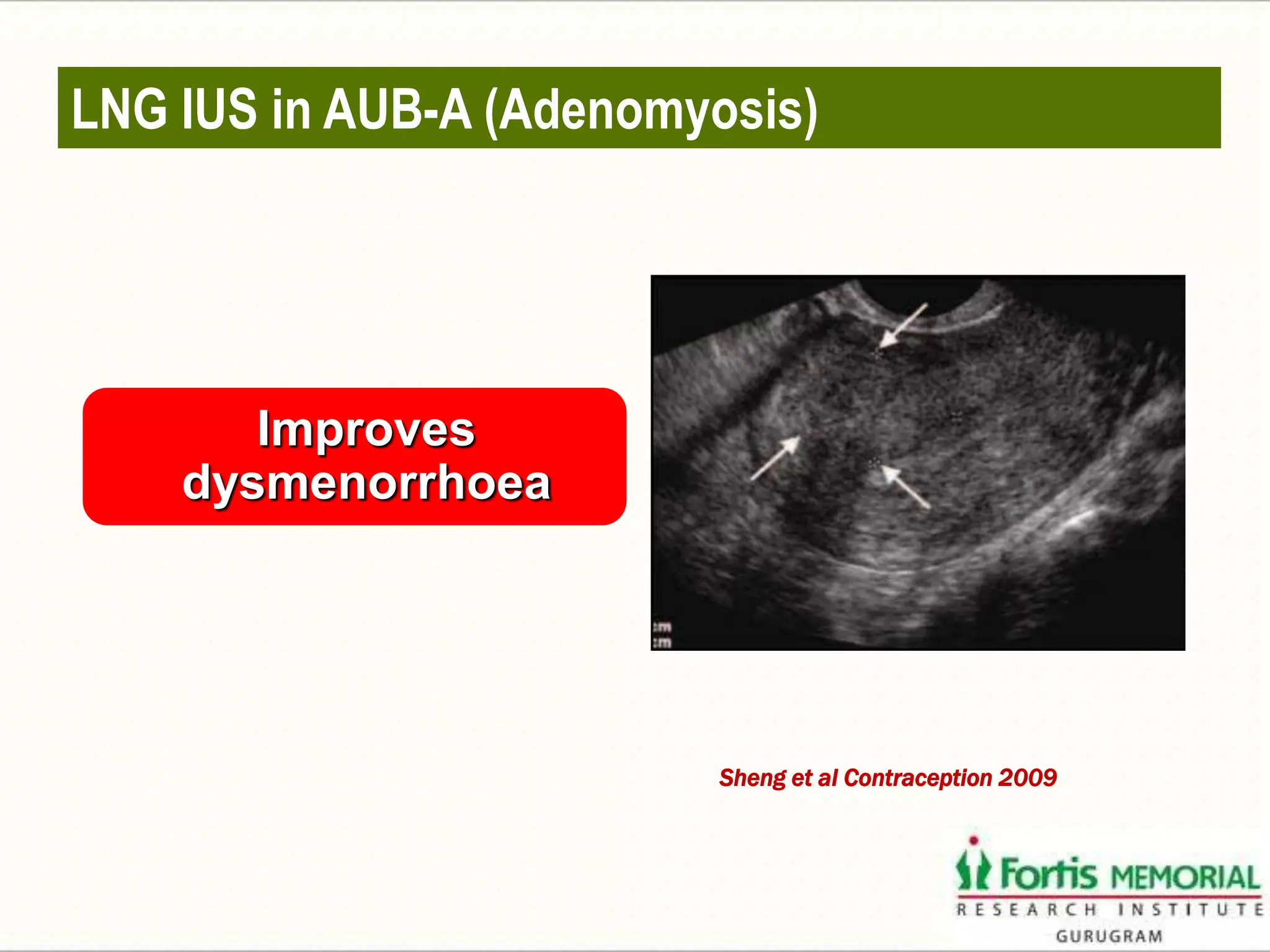 Mirena: An emerging tool in managing abnormal uterine bleeding | PPTX