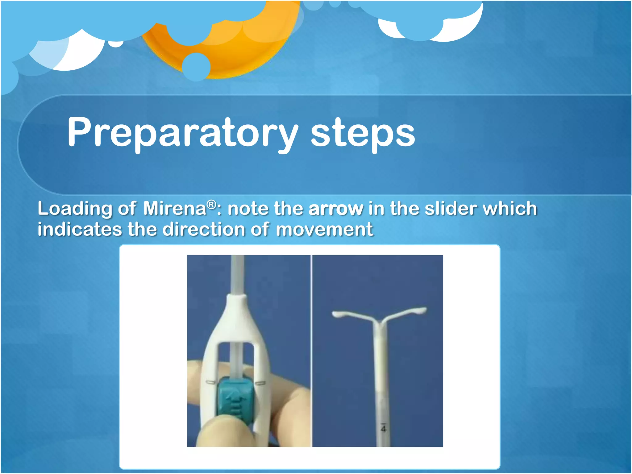 Mirena evo insertion | PPTX