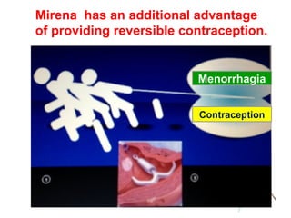 Mirena its role in menorrhagia dr. jyoti bhaskar,lecture -3 | PPT