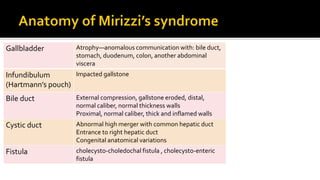 Mirizzi syndrome | PPTX