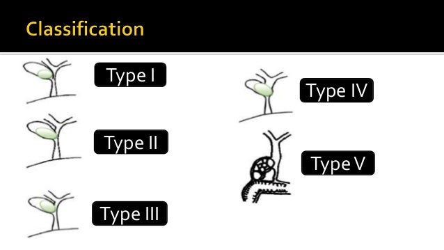 Mirizzi Syndrome Classification