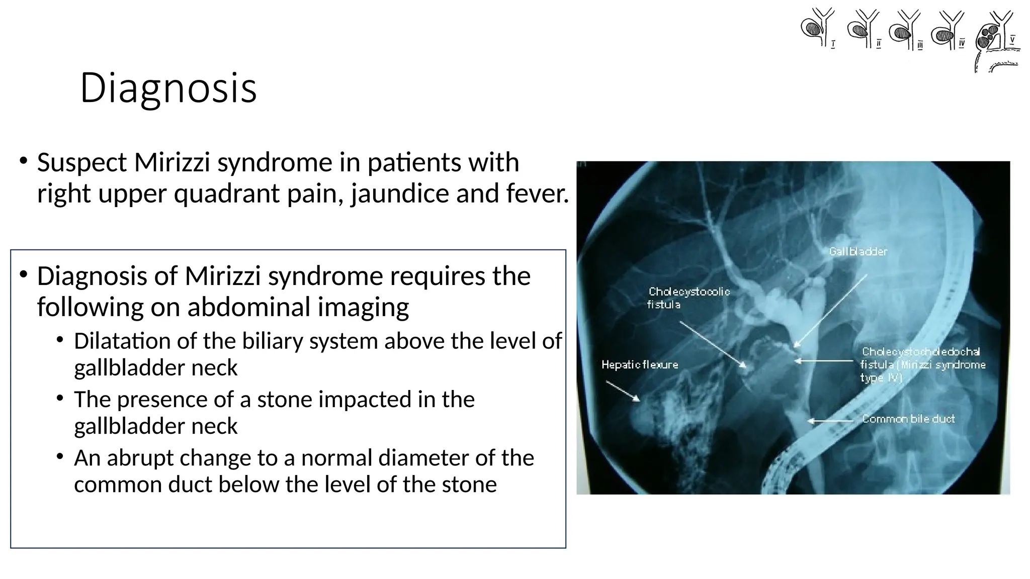 Management and diagnosis of Mirizzi syndrome.pptx
