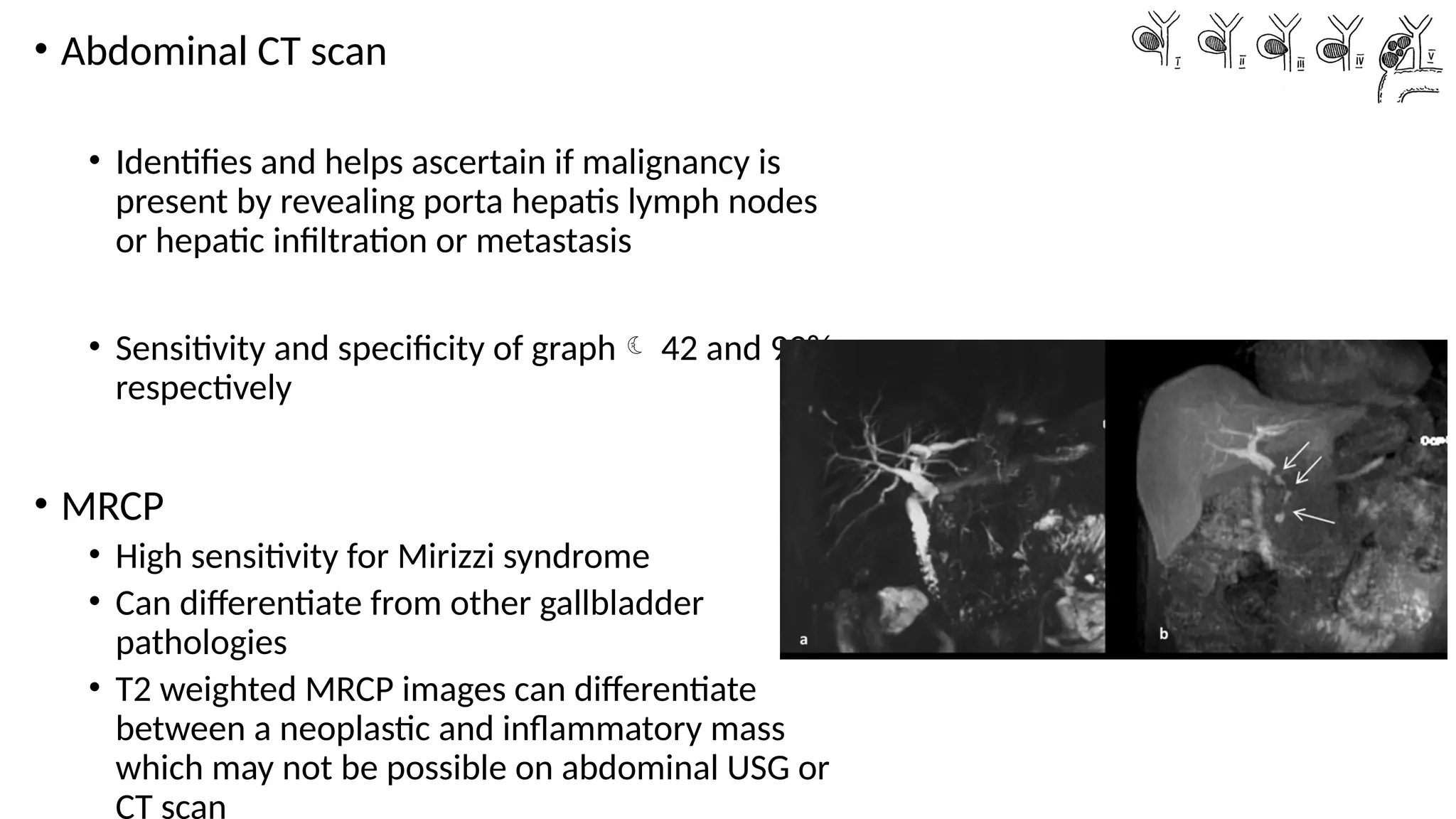Management and diagnosis of Mirizzi syndrome.pptx