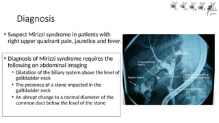 Management and diagnosis of Mirizzi syndrome.pptx