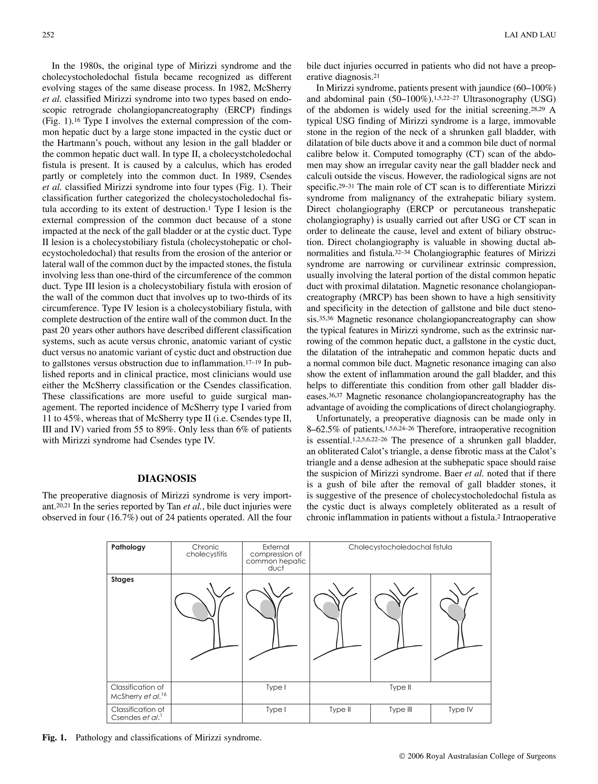 Mirizzi syndrome history, present and | PDF